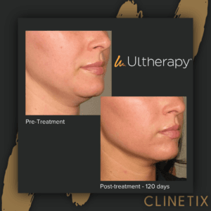 Ultherapy-Before-After-Insta | Clinetix